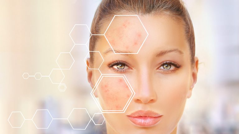 Ritirati cinque lotti di crema anti acne Airol - SOCIALFARMA